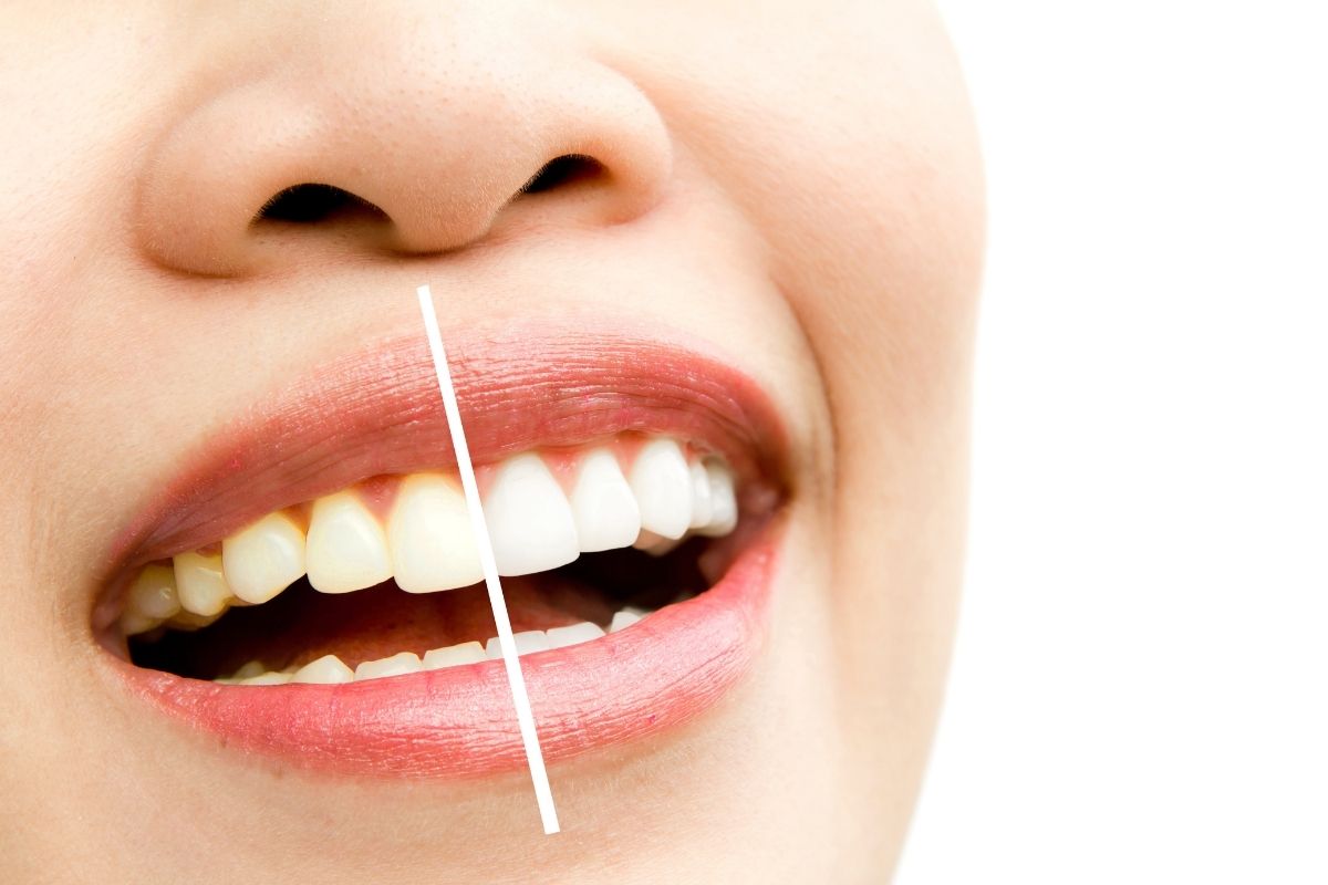 La tecnologia CAD CAM: denti perfetti in una soluzione unica