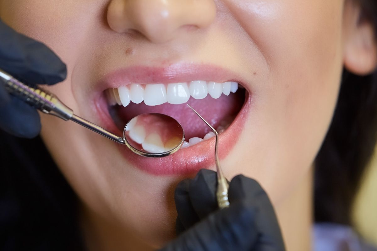 Faccette dentali: quando sono necessarie - Dental Arca