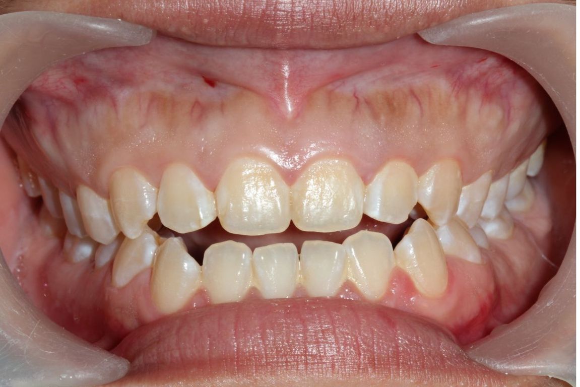 Come Risolvere il Morso Aperto: Trattamenti Efficaci - Dental Arca