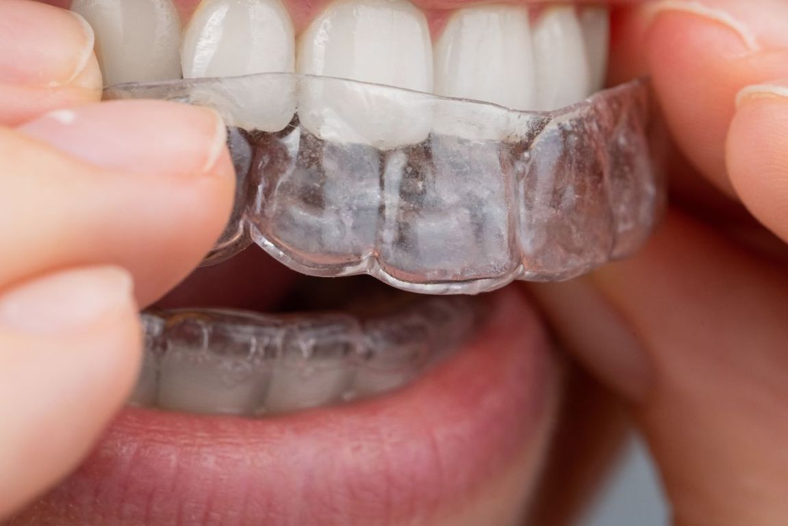 Come funziona l'apparecchio invisibile? - Dental Arca