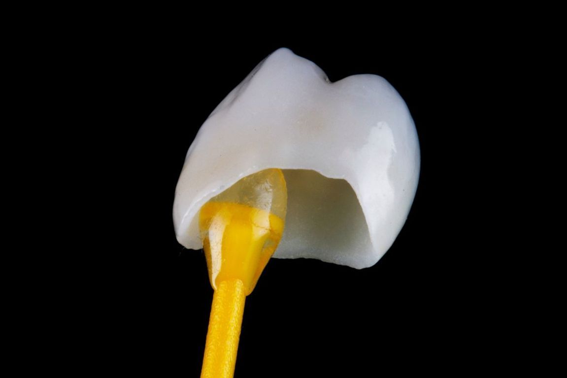 Corone metal free: cosa sono e in quali materiali sono realizzate ...